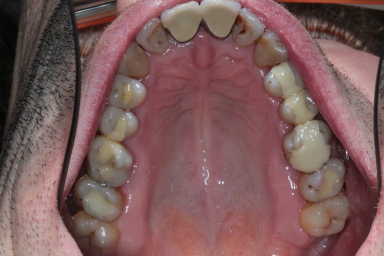 Zahnfüllungen – Praxiszentrum Brüderstrasse Herford